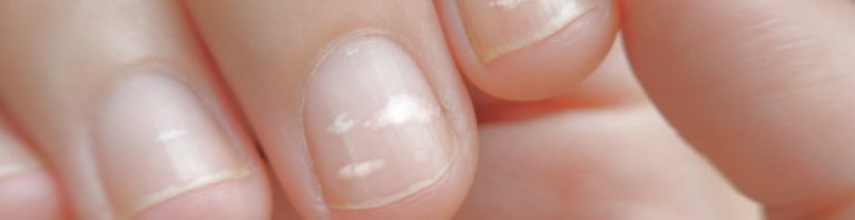 Causes Of Nail Detachment | Jacob Stack