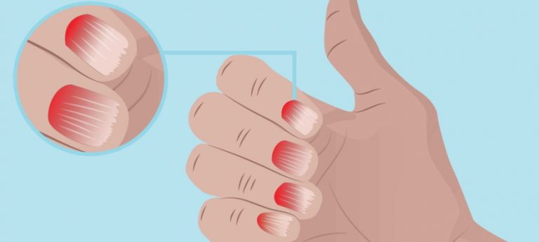 Causes Of Nail Detachment | Jacob Stack